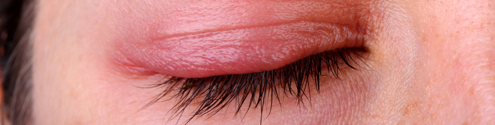 Blepharitis | Goepfert Eye Associates